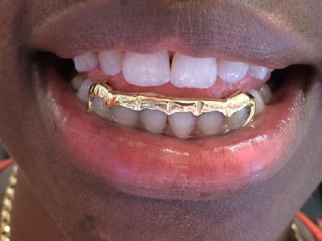 14k gold Overlay Removable gold teeth caps Grillz - Fashion Jewelry
